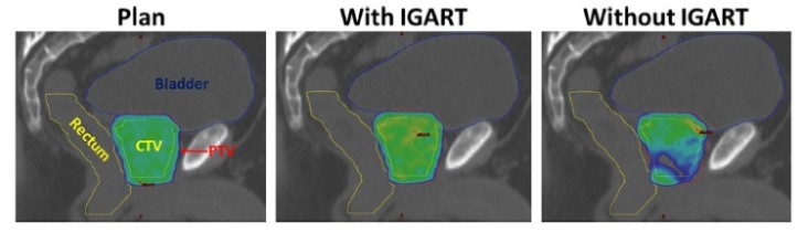 Real-time image-guided ART achieved on a standard linac – Physics World