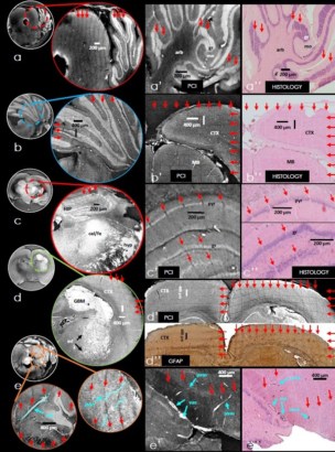Phase-contrast CT reveals impact of microbeam radiotherapy – Physics World