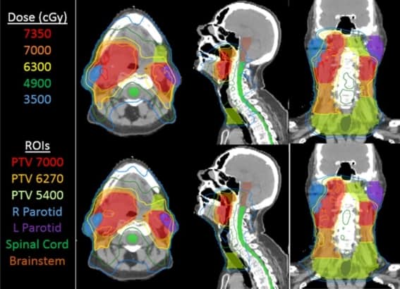Compensator expands global access to advanced radiotherapy – Physics World