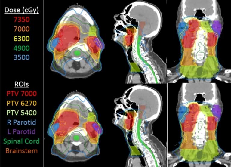 Compensator expands global access to advanced radiotherapy – Physics World
