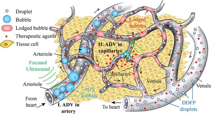 Gas-trapping structures improve tumour treatment – Physics World