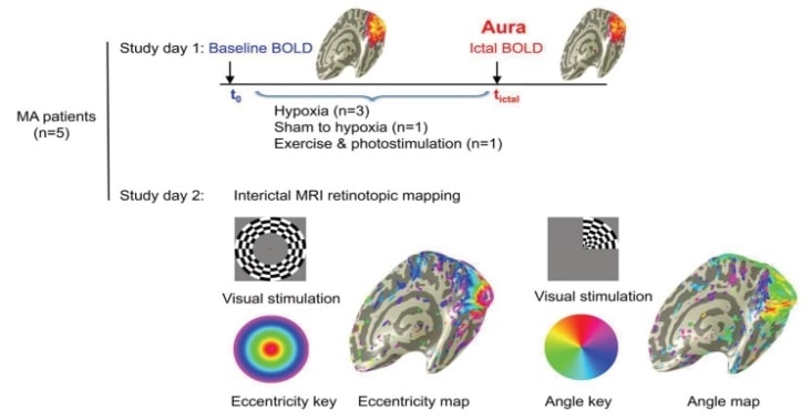 Exploring the visual symptoms of migraine – Physics World