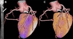 Cardiac hybrid imaging predicts adverse cardiac events – Physics World