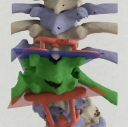 3D printing facilitates complex spinal surgery – Physics World