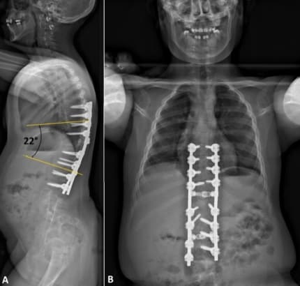 3D printing facilitates complex spinal surgery – Physics World
