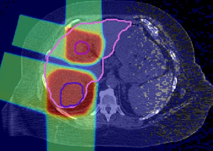 Variable RBE impacts proton therapy of liver cancer – Physics World