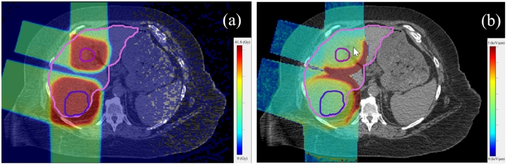Variable RBE impacts proton therapy of liver cancer – Physics World