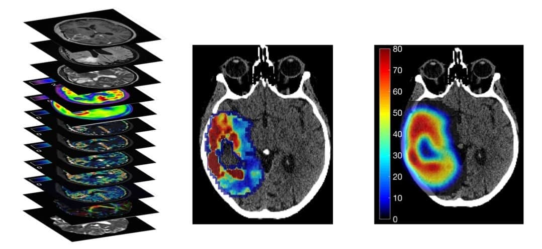 Multi-modality imaging predicts tumour recurrence – Physics World