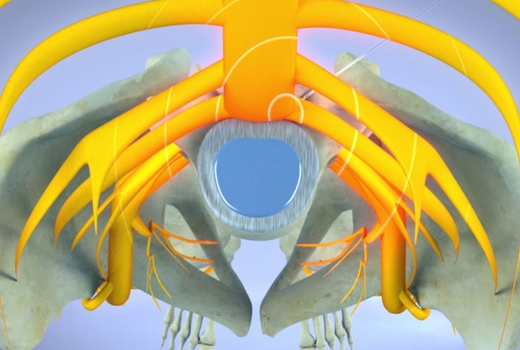 Pulsed radiofrequency therapy relieves acute back pain – Physics World