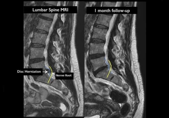 Pulsed radiofrequency therapy relieves acute back pain – Physics World