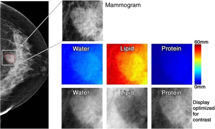 Image analysis technique may reduce unnecessary breast biopsies ...