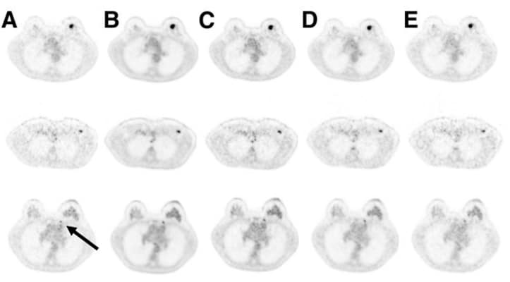 TOF PET/MRI reduces dose for breast cancer detection – Physics World