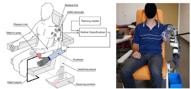 Phantom limb movement controls a robotic arm – Physics World