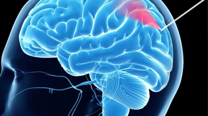 Biopsy needle makes brain surgery safer – Physics World