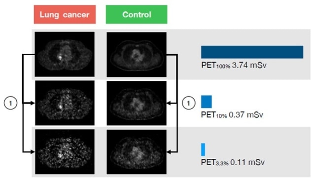 Ultralow-dose FDG-PET gives boost to lung cancer screening – Physics World