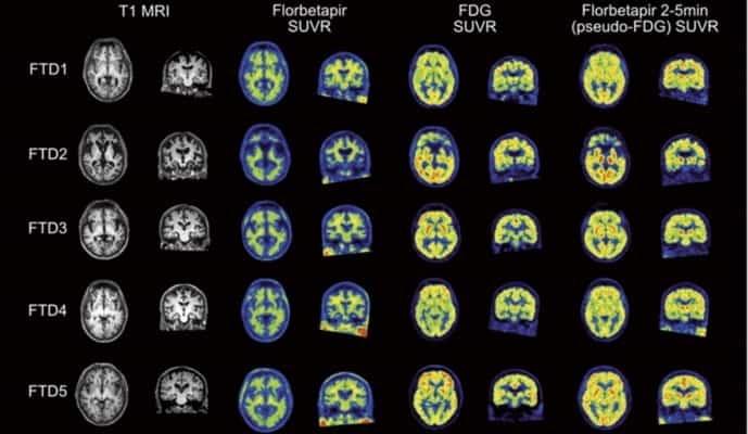 PET tracer offers dual diagnosis – Physics World