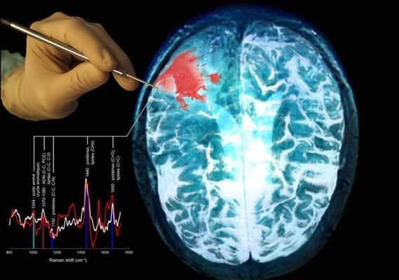 Raman imaging plus AI classifies brain cancers during surgery – Physics ... Raman imaging plus AI classifies brain cancers during surgery – Physics ...