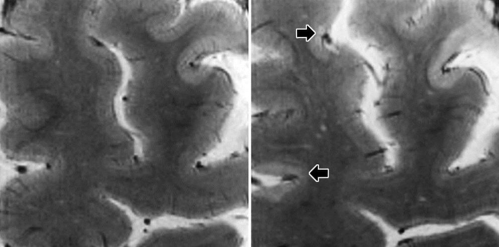 Ultrahigh-field MRI tracks multiple sclerosis progression – Physics World