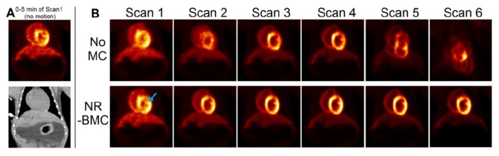 Motion correction enables quantitative PET scans – Physics World