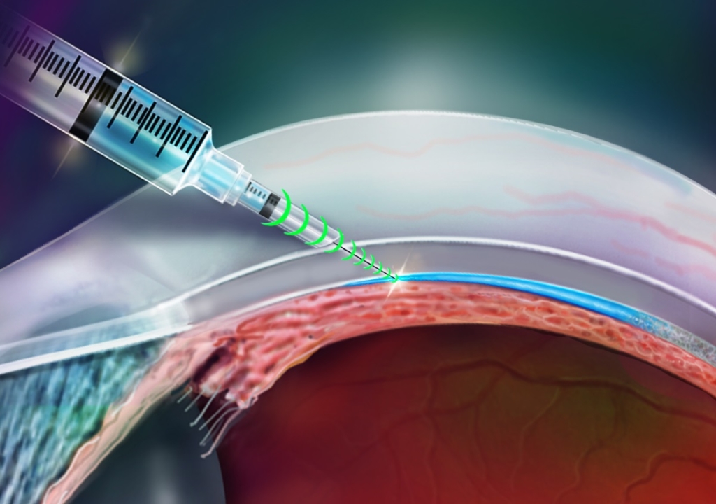 Smart intravenous needle softens upon insertion into a blood vessel ...