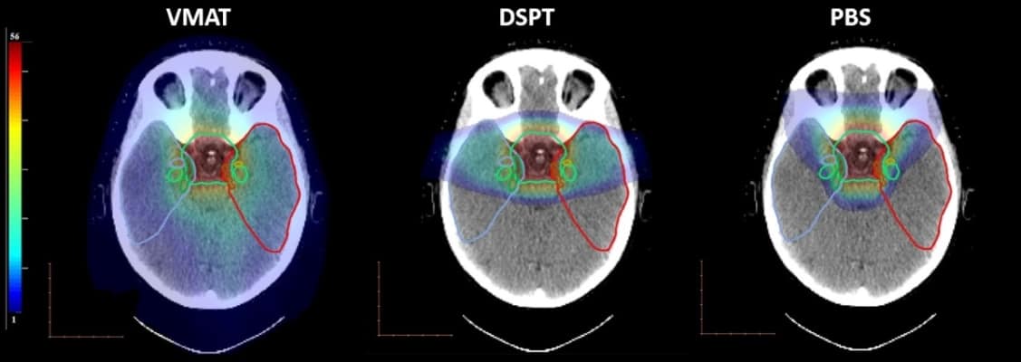 Pencil-beam protons protect memory in children with brain tumours ...