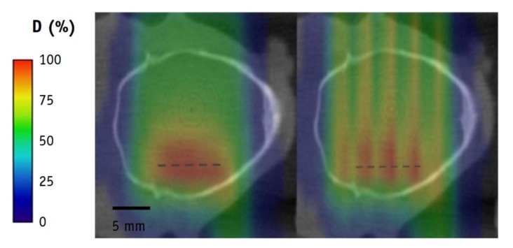 Minibeam radiotherapy: from photons to charged particles – Physics World