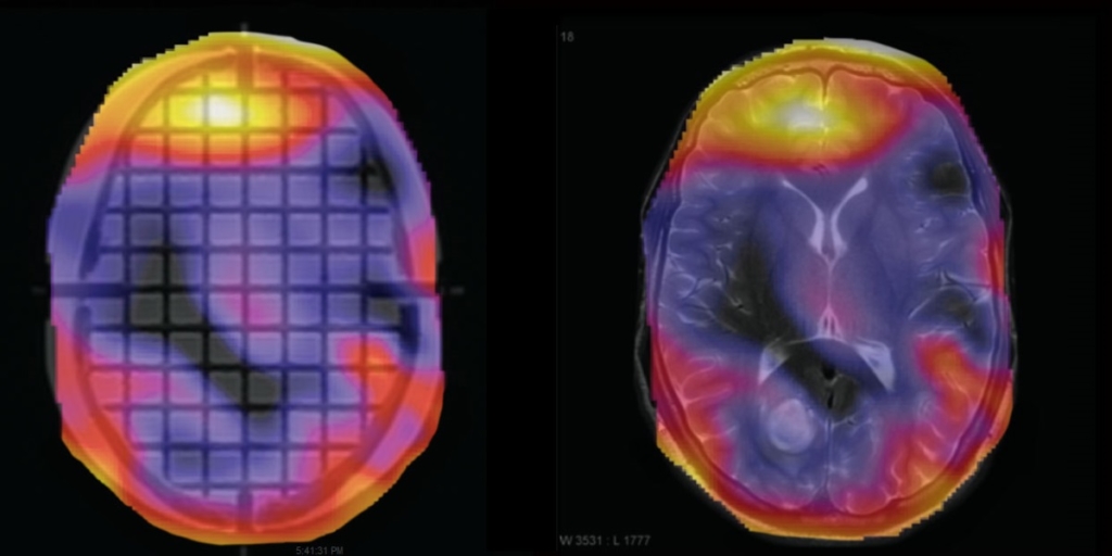 Getting to grips with MR image distortion – Physics World