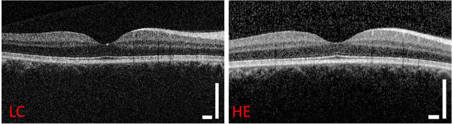 Low-cost eye scanner could increase worldwide access to retinal imaging ...