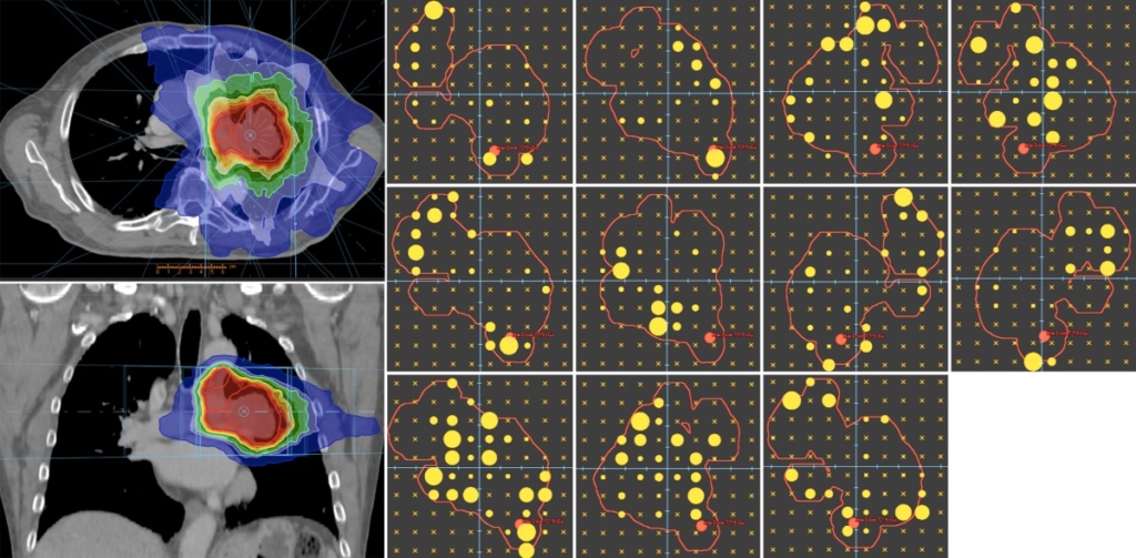 PHASER linac will translate FLASH radiotherapy to the clinic – Physics ...
