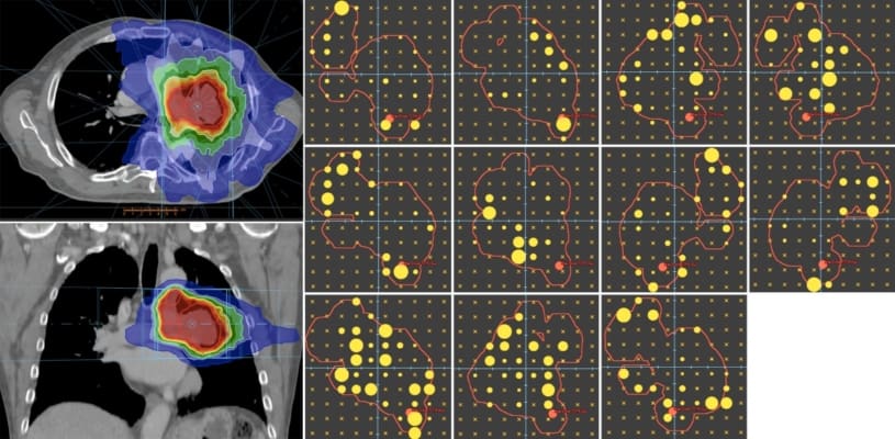 PHASER linac will translate FLASH radiotherapy to the clinic – Physics ...