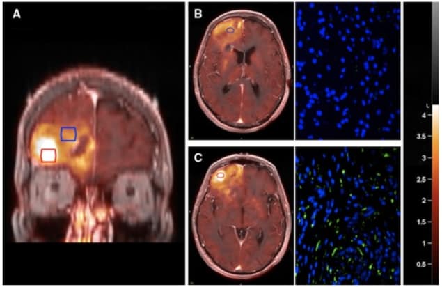 Amino acid PET tracers hold great promise for brain tumour management ...