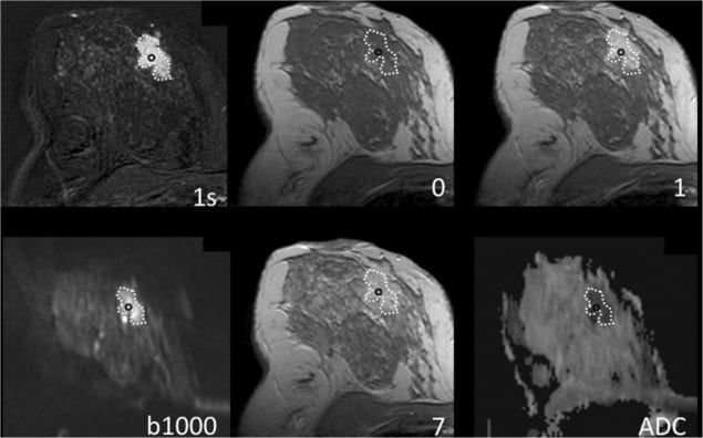 Diffusion-weighted imaging can streamline breast MRI – Physics World