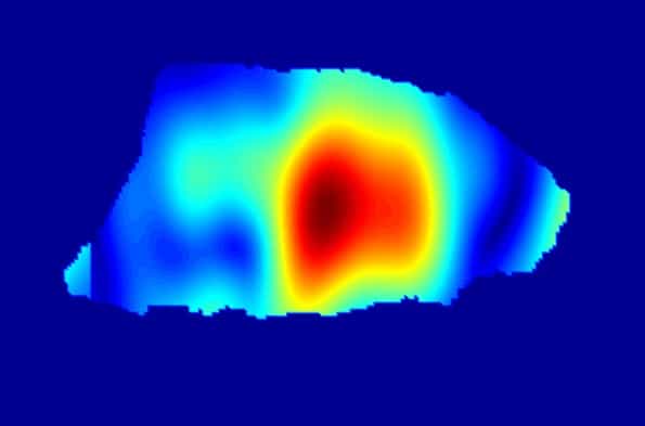 Millimetre-wave imaging delivers non-invasive skin cancer diagnosis ...
