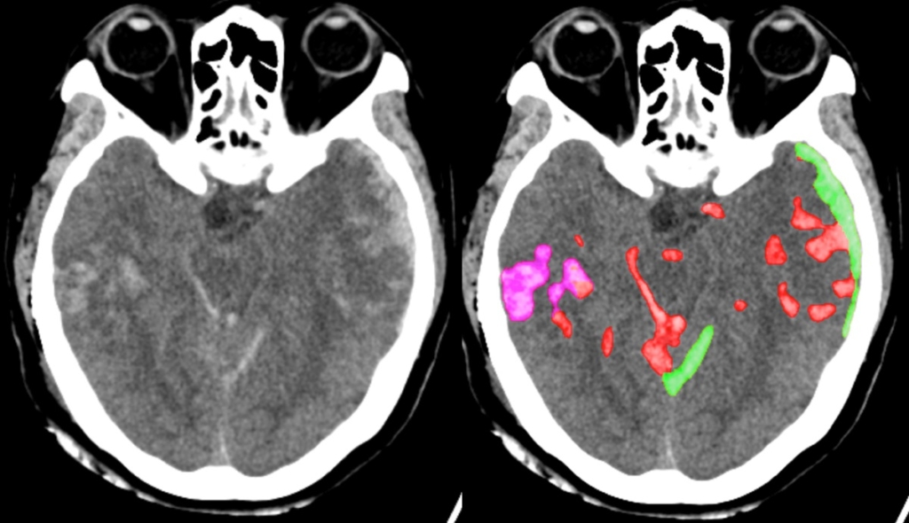 Deep learning speeds triage of brain scans – Physics World