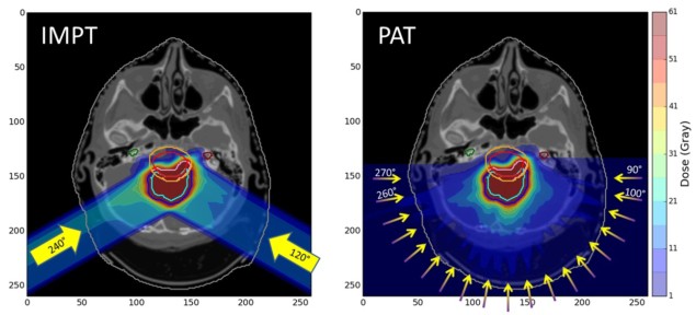 Proton arc therapy: the next evolution in proton delivery? – Physics World