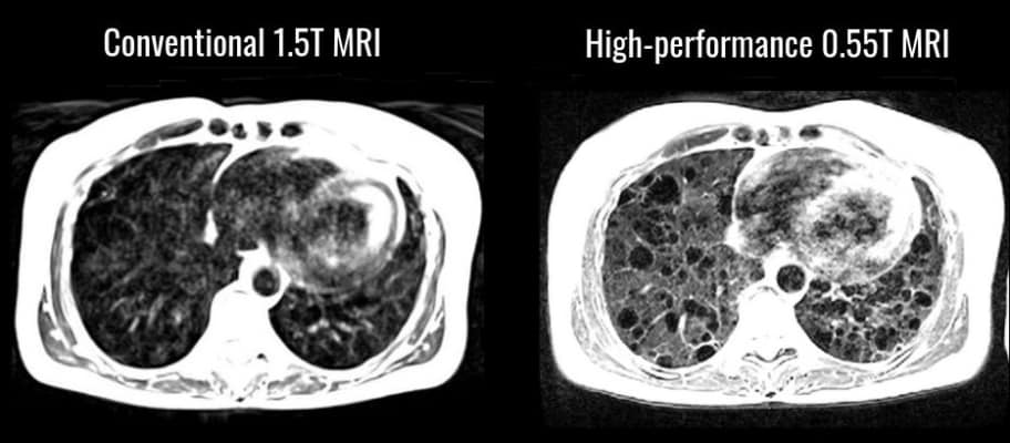 High-performance, low-field MRI improves lung imaging – Physics World