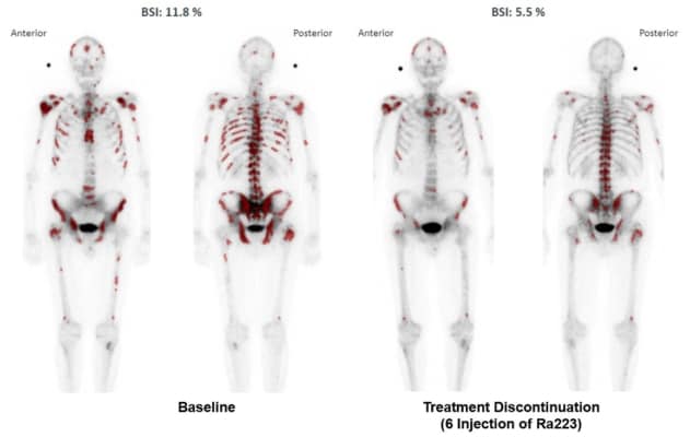 Automated algorithm determines patient's response to Ra-223 therapy ...