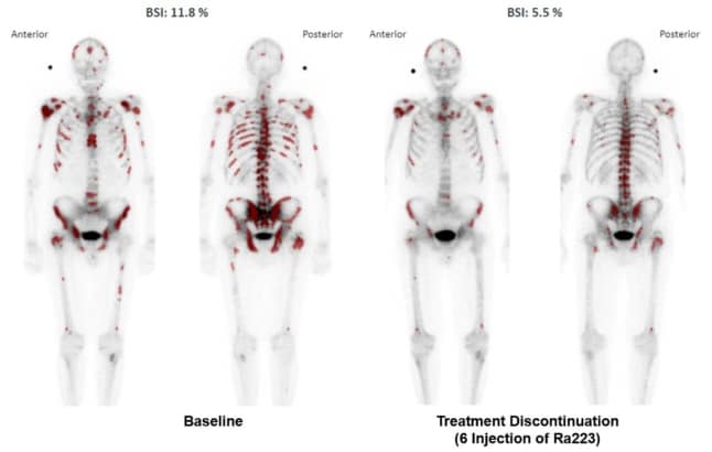 Automated algorithm determines patient's response to Ra-223 therapy ...
