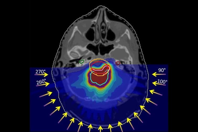 Proton arc therapy: the next evolution in proton delivery? – Physics World