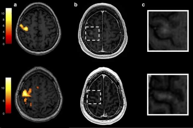 Ultrasound could enable future treatments for motor neurone disease ...