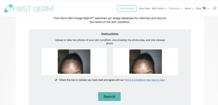 AI dermatology tool needs more diverse skin types in its training ...