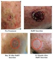 Alpha DaRT treatment proves a success in first-in-human trial – Physics ...