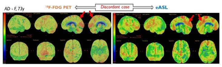 FDG-PET displays its prowess in dementia detection – Physics World