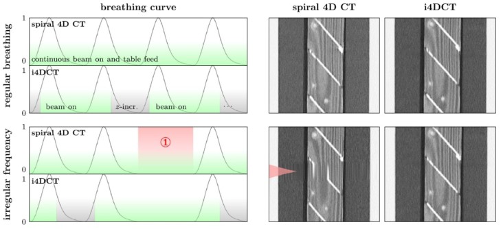 Intelligent 4D CT reduces image artefacts – Physics World