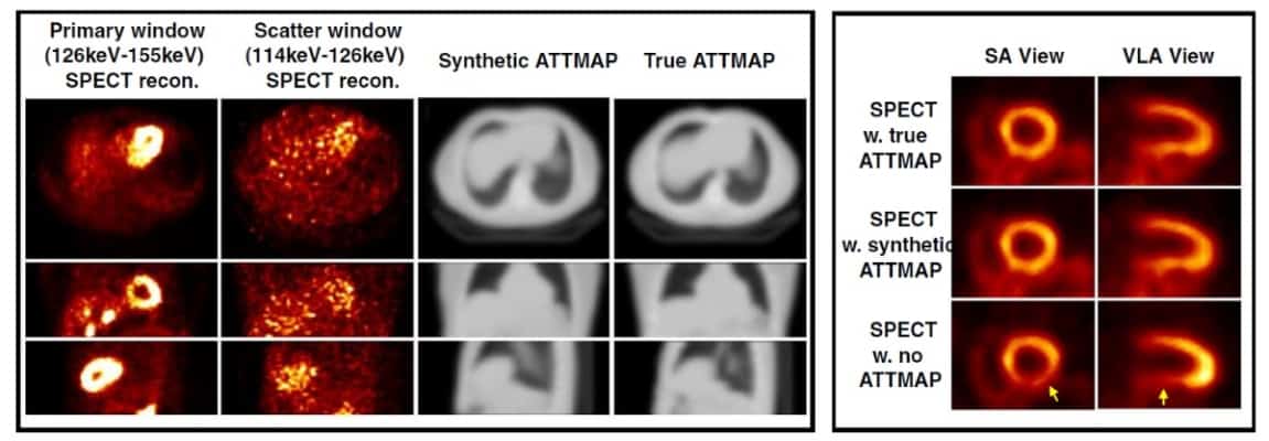 Deep learning improves cardiac images from SPECT-only scanners ...