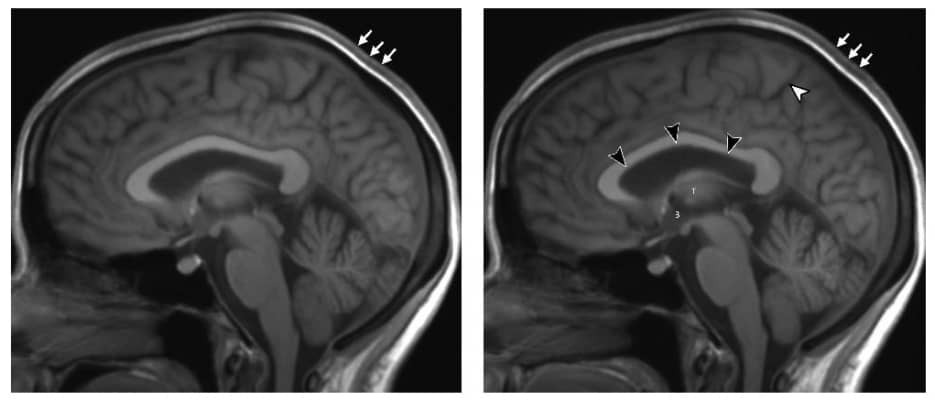 MRI reveals long-term effects of space travel on the brain – Physics World