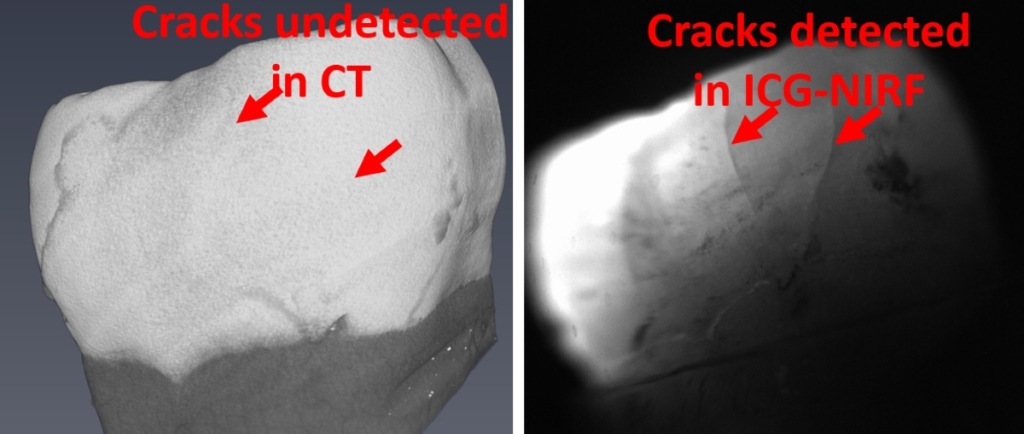 Near infrared fluorescence imaging provides early diagnosis of cracked ...