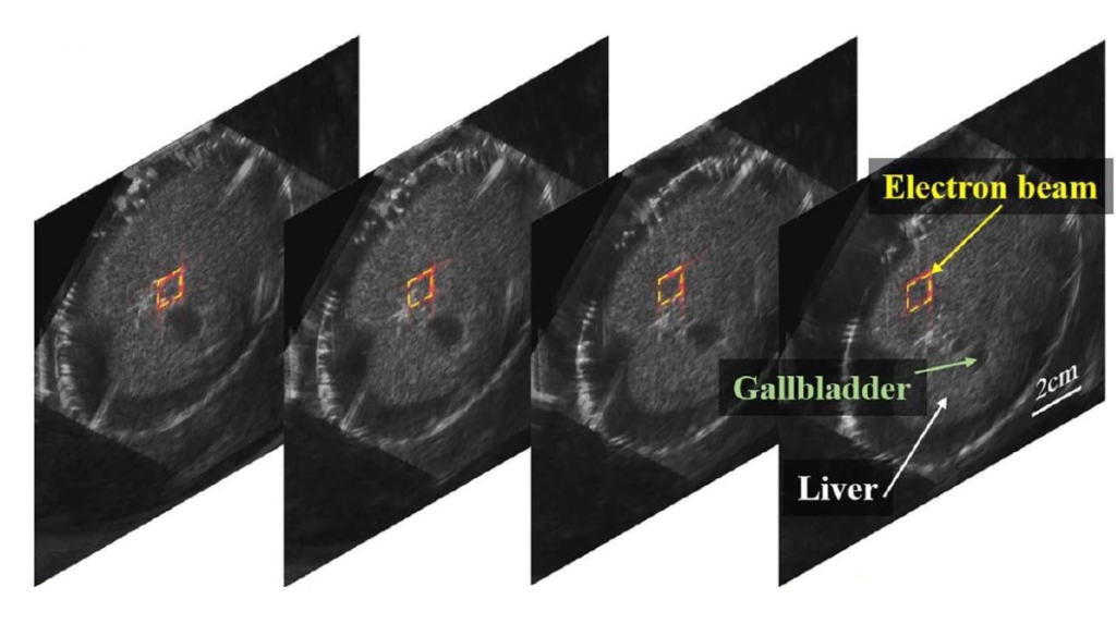 Dose tracking during radiotherapy could enable safer cancer treatments ...
