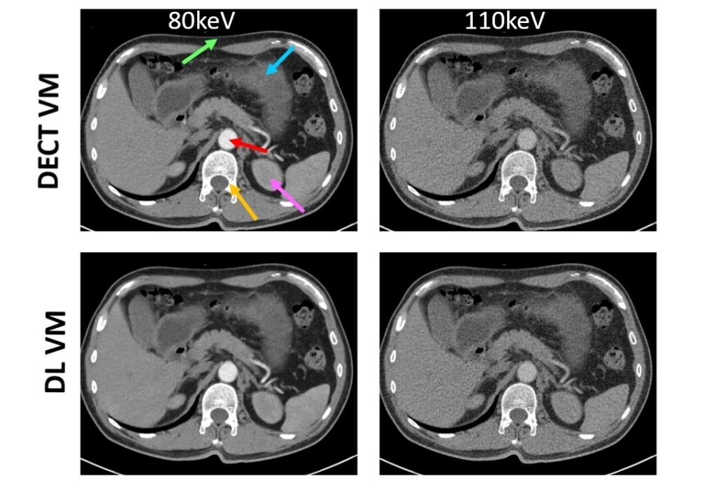 Deep learning transforms standard CT scans towards spectral images ...