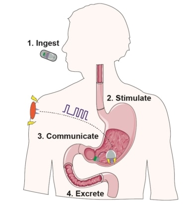Tiny ingestible capsule helps treat gastrointestinal disorders ...